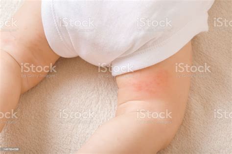 피부에 붉은 발진이있는 유아 맨발 우유 분유 모유 또는 기타 음식의 알레르기로 고통받습니다 아기의 몸을 걱정하십시오 근접 촬영