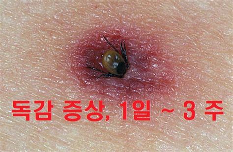 진드기 진드기에 물리지 않는 예방법 및 진드기에 물렸을때 응급조치하는 방법은 무엇일까 네이버 블로그