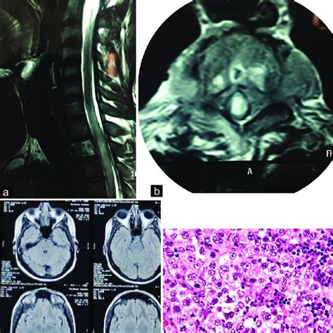Magnetic Resonance Imaging Cervical Spine Saggital Demonstrated