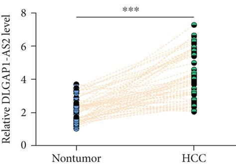 A High Level Of Dlgap1 As2 In Hcc Predicted Poor Survival Expression