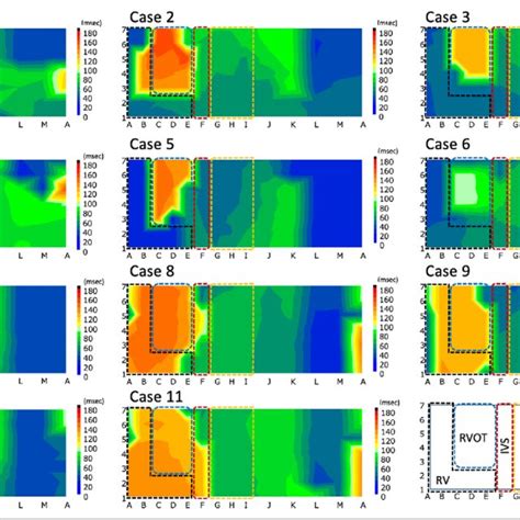 Ventricular Activation Time Map In The Brugada Syndrome Group Download Scientific Diagram