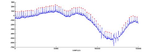 Qrs Detection Applied To 426mdat From Mit Bih Malignant Download Scientific Diagram