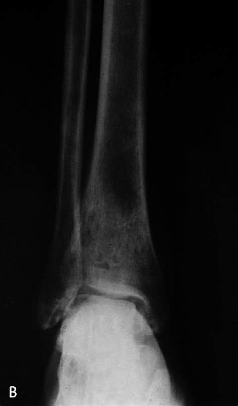 A Preoperative X Rays Showing Lytic Lesion In Lower Tibia Download