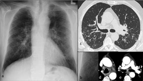 Frontal Chest Radiograph A Show A Bilateral Reticular Opacities Ct