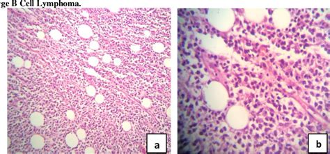 Figure 1 From Diffuse Large B Cell Lymphoma Mimicking A Large Soft