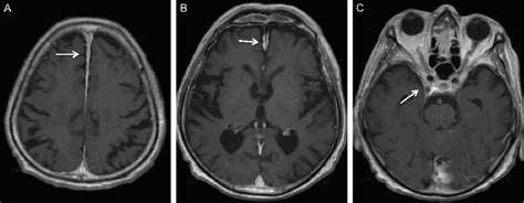 Gadolinium Enhanced T1 Weighted Magnetic Resonance Images On Admission