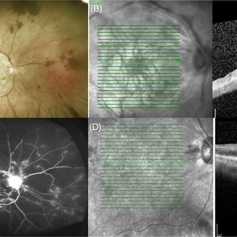 Combined Central Retinal Arteryvein Occlusion And Exudative Retinal
