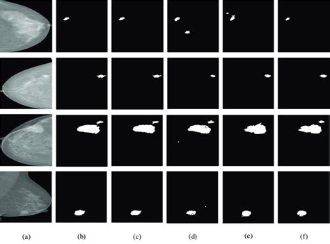 Segmentation Results Of Four Samples On Inbreast Dataset From Left To