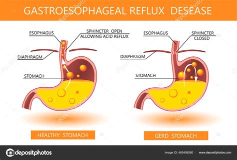 Gastroesophageal Reflux Disease 3d Acid Reflux Heartburn And Gerd