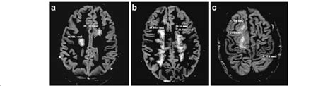 Axial Dir Images Showing Contouring And Segmentation Method Of Ms Download Scientific Diagram