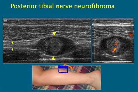 Peripheral Nerve Lesions Role Of High Resolution Us Radiographics
