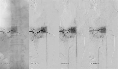 Spinal Artery Test Occlusion And Sacrifice For Tumor Embolization