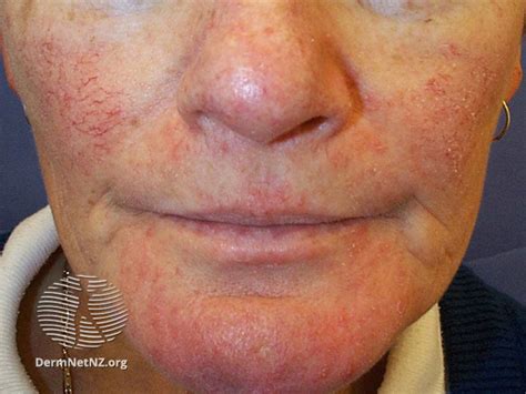 Seborrheic Dermatitis Vs Rosacea 6 Similarities And Differences