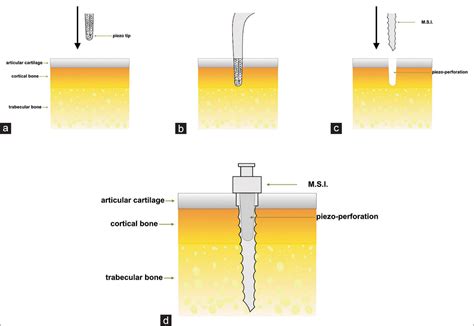 Cortical Piezo Puncture As A Minimally Invasive Method For Reducing