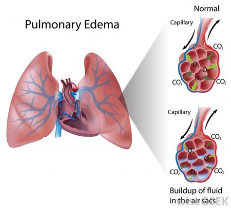 Alveolar Pulmonary Edema