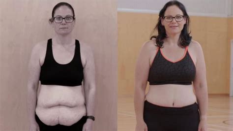 Excess Skin Removal Surgery In Thailand I Went From 140kg To 76kg