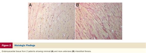 Figure 1 From Evaluation Of Diffuse Myocardial Fibrosis In Heart