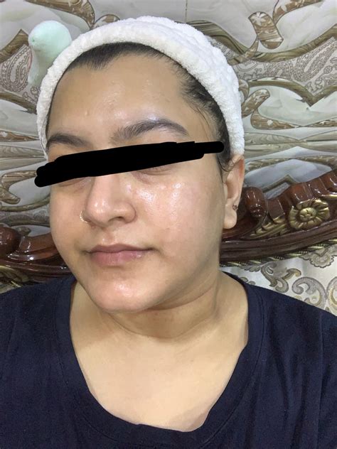 Scared To Use Tret R Tretinoin
