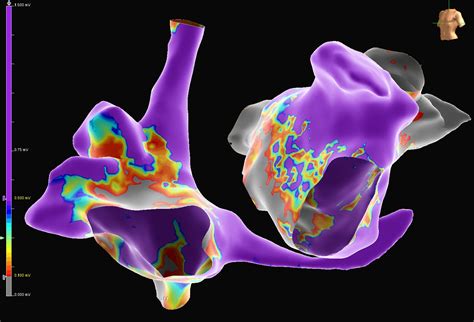 Iatrogenic Biatrial Flutter The Role Of The Bachmanns Bundle Cardiac Anatomy For