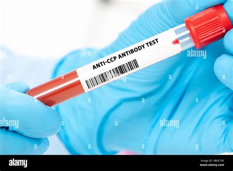Anti Ccp Antibody Test Detects Anti Cyclic Citrullinated Peptide