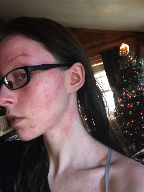 Sensitive Skin Or Allergic Reaction Beauty Insider Community