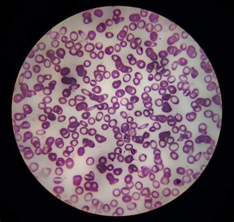Acute Thrombocytopenia And Leukocytopenia Analysed By Microscope Stock
