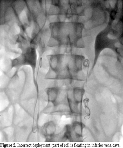 Figure 1 From Complications And Side Effects After Pelvic Vein Embolization Semantic Scholar