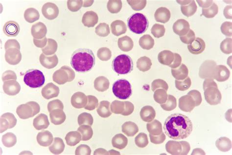 Fda Approves Lillys Jaypirca For Chronic Lymphocytic Leukemia Small Lymphocytic Lymphoma