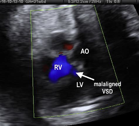 Fetal Echocardiogram Showing A Malaligned Vsd In The Four Chamber View