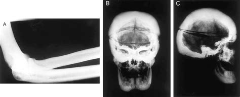 Figure 1 From Van Buchem Disease Hyperostosis Corticalis Generalisata Maps To Chromosome 17q12