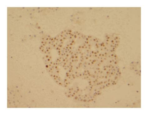 Cell Block Section Case 6 Showing Tumor Cells With Immunopositivity