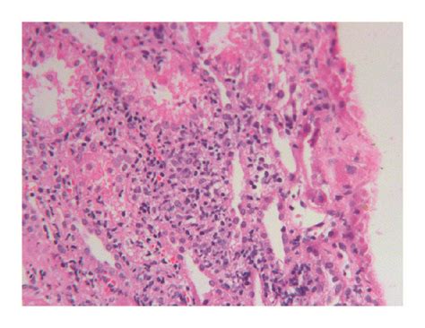 Photomicrograph Showing Dense Chronic Lymphoplasmacytic Interstitial Download Scientific