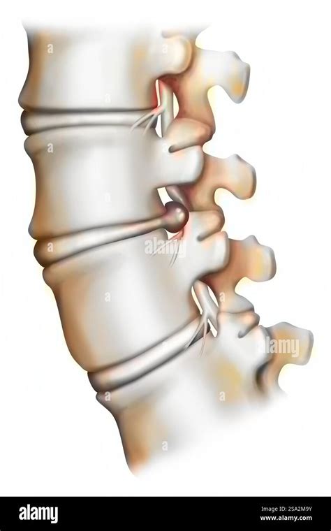 Herniated Disc A Herniated Disc Is A Protrusion Of An Intervertebral Disc Which Can Then