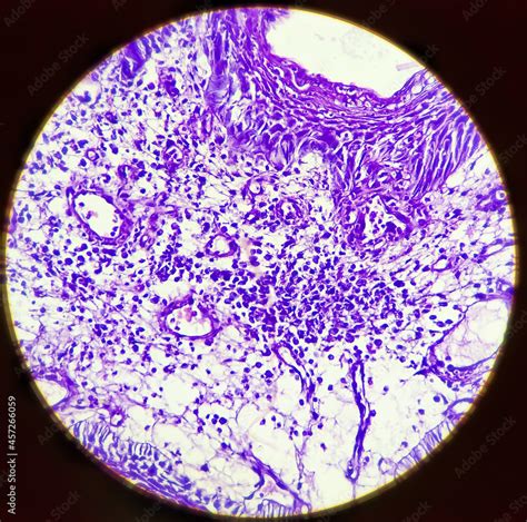 Cancer Of Esophagus Poorly Differentiated Adenocarcinoma In A Patient