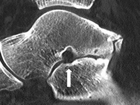 The Canalis Tarsi Between The Middle And Posterior Subtalar Facets Download Scientific Diagram