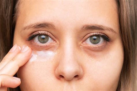Under Eye Bags Causes And Ways To Get Rid Of It
