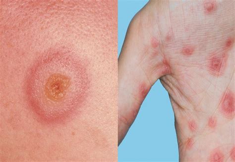 Erythema Multiforme HSE Ie