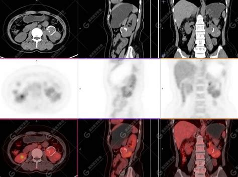 Pet Ct