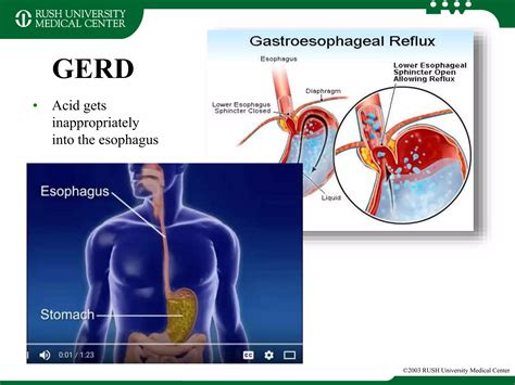 Scleroderma And The Gi Tract Ppt