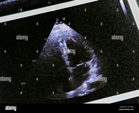 Echocardiography Or Cardiac Ultrasound Shows Normal Values Except For