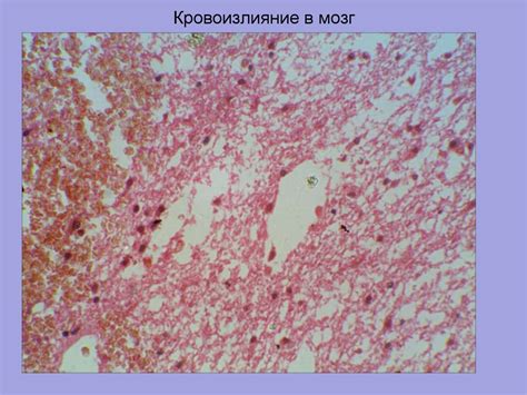 Кровоизлияние в мозг презентация онлайн