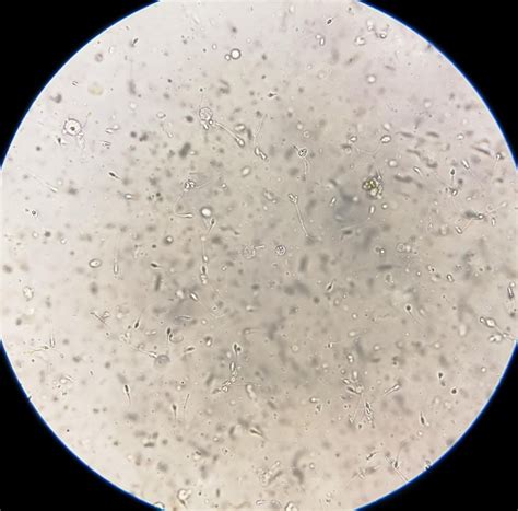 Semen Analysis Under Microscopy Showing Pyospermia Or Leukocytospermia