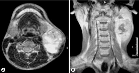 Figure 1 From Synovial Sarcoma Of The Neck Semantic Scholar