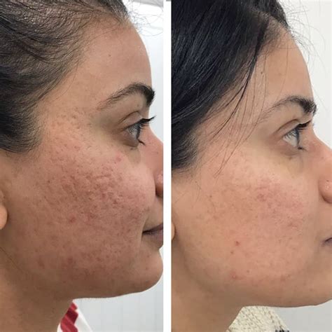 How To Identify Micro Needling Before And After Wrinkles