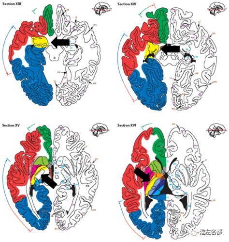 影像读片（43）：少见的大范围脉络膜前动脉区急性梗死，合并临近的颈内动脉重度狭窄 脑医汇