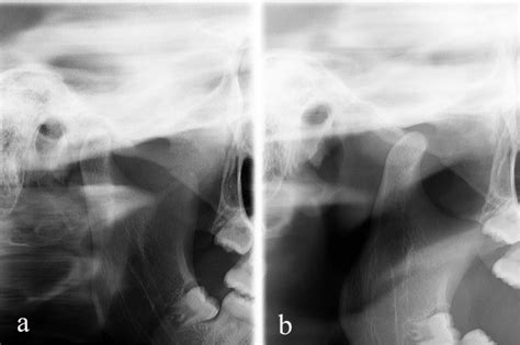 Temporomandibular Joint X Ray