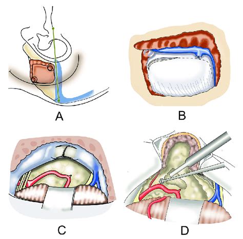 Técnica Quirúrgica I Incisión Retroauricular Curvilínea A Área De