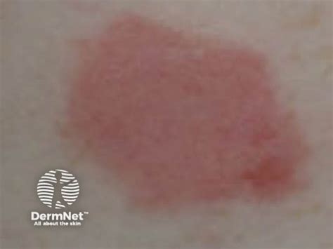 Baseline Series Of Patch Test Allergens