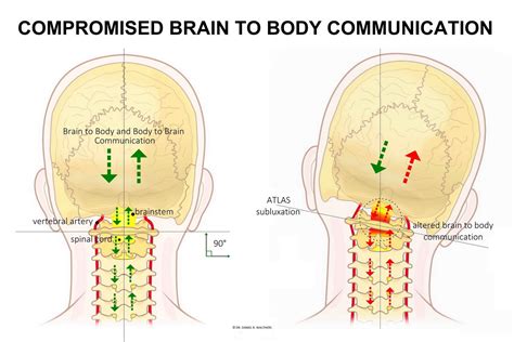 Upper Cervical Subluxation