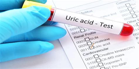 Uric Acid Test Normal Range High Vs Low Levels In Blood